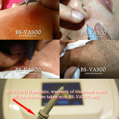 China portable spider veins vascular removal machine supplier