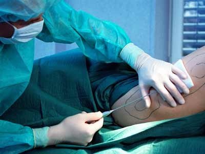 Power assisted liposuction BS-LIPS3 supplier