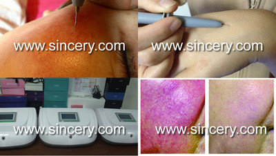 vascular blemish machine high frequency vascular elimination system Va300 supplier
