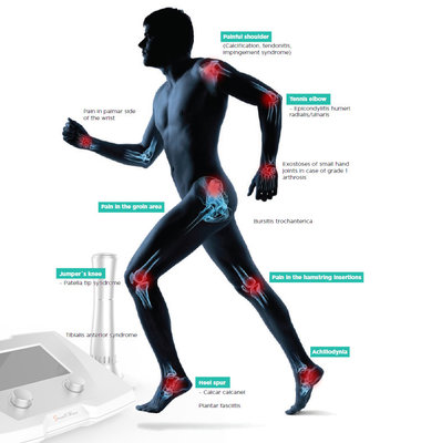 Extracorporal Shock Wave Therapy For Erectile Dysfunction Shockwave Therapy Back Pain Relief Equipment supplier