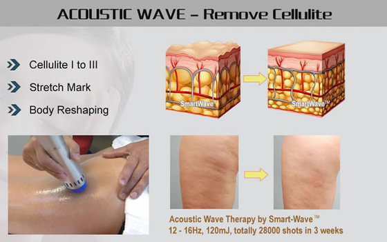 Shock wave therapy equipment Medical EDSWT for Vasculogenic and diabetic ED patients supplier