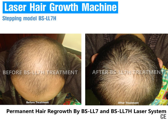 Laser hair regrowth equipment Beauty Salon Laser Hair Regrowth Machine For Hair Loss Treatment factory direct wholesale supplier