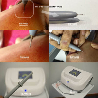 Vein Vascular removal vascular spider vein removal 30MHz high frequency beauty equipment supplier