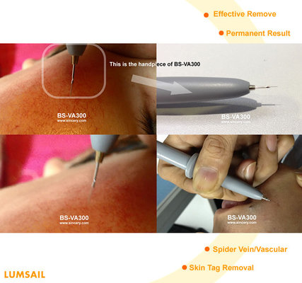 Latest Vein Vascular removal vascular lesions spider vein removal machine blood vessels removal supplier