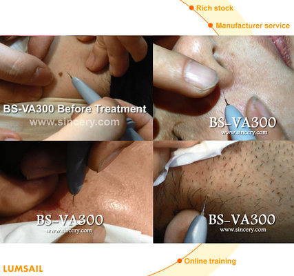 Vein Vascular removal Spider vein removal mahcine RBS veins remover supplier