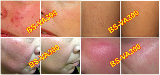 Vein Vascular removal High frequency vascular removal beauty machine coagulation vessels vein laser equipment for spider supplier