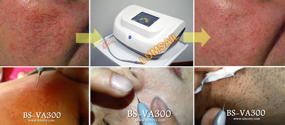 Vein Vascular removal vascular spider vein removal machine for skin care supplier