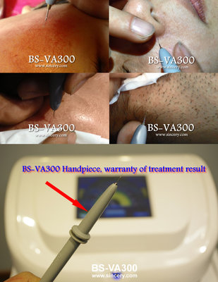 Vein Vascular removal spider vein korea vascular removal machine supplier