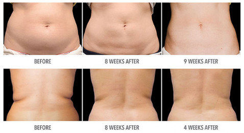 Cryolipolysis slimming equipment cryolipolysis fat freeze slimming machine supplier