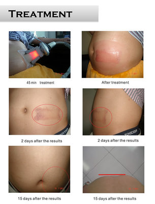 Cryolipolysis slimming equipment Europe popular 4 handpieces cryomed cryolipolysis rf slimming machine supplier