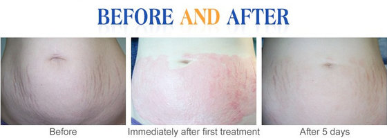 Anti aging 180 & 540 & 600 needles LED derma roller with Medical CE supplier