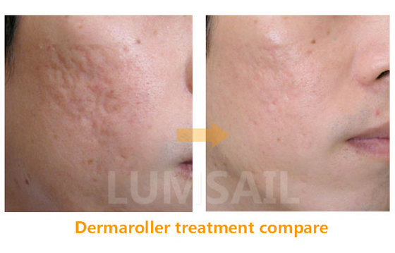 dermapen electric derma pen anti-hair removal pen derma & derma pen needle cartridge supplier