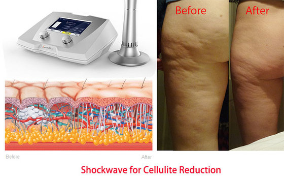 Acoustic shockwave therapy pain relief electromagnetic wave shock wave therapy for heel pain supplier