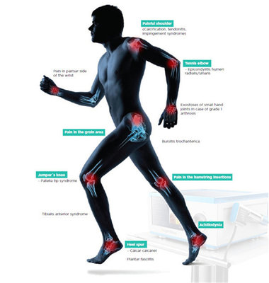 physiatrist use BS-SWT5000 Lumsail shock wave device for Patellar tendinopathy supplier