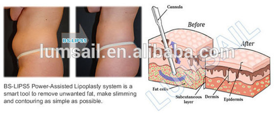 Power Assisted Liposuction Machine Intervention therapy fat suction supplier