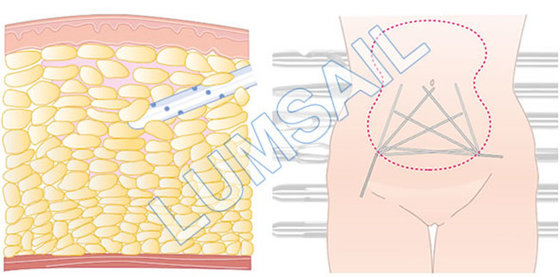 Body Contouring Power Assisted Liposuction Equipment For Body Sculpting Treatments supplier