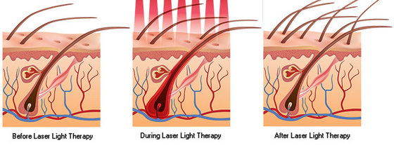 Laser hair regrowth Low Level Laser Hair Restoration Lamp Laser hair care hair loss supplier