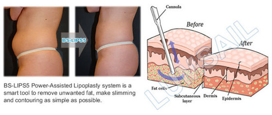 electric liposuction resonance ancillary device for plastic surgery aspirator machine supplier