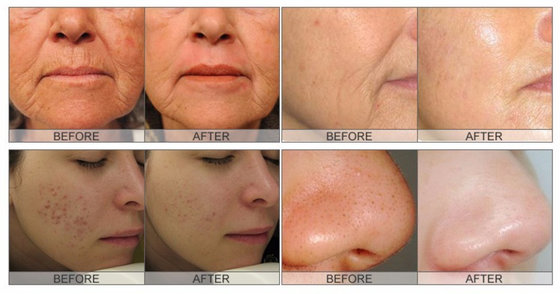 Multifunction Diamond Hydro Microdermabrasion Machine Non Surgical for Facial Lift supplier