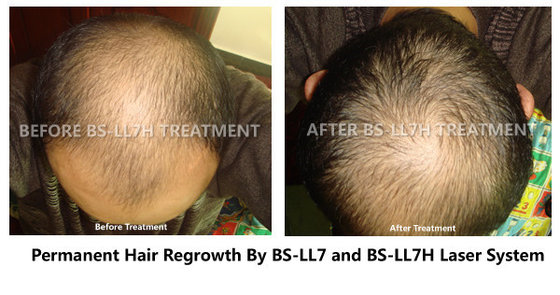 Hot Newest Biological PDT LED Diode Laser Hair Growth Machine supplier