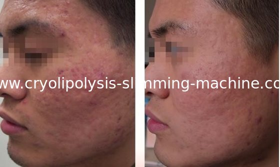 Smart design with good quality! face lifting portable fractional rf microneedle machine