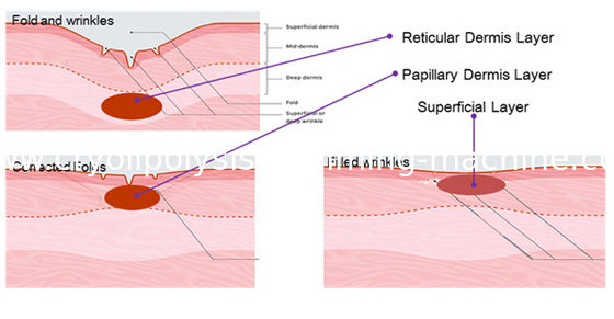invasive and noninvasive fractional rf microneedle machine with skin rejuvenation treatmen