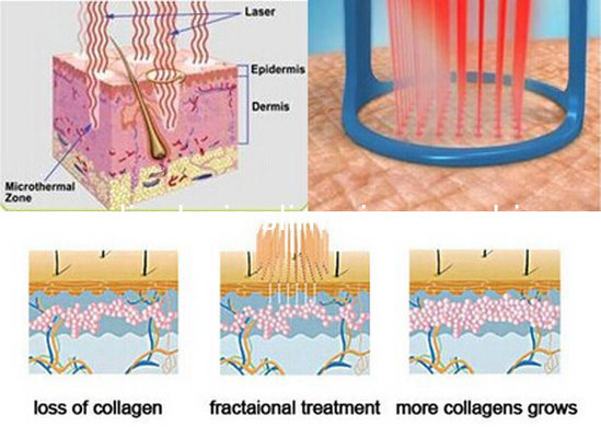 laser resurfacing machine Co2 fractional laser machine multi-functional laser co2 machine