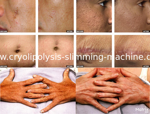 laser resurfacing machine Co2 fractional laser machine multi-functional laser co2 machine