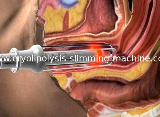 2018 newest 40W big power RF tube Fractional CO2 laser machine with vaginal tightening