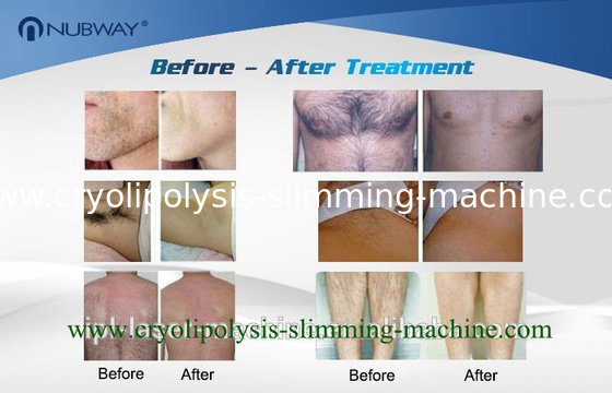 German Diode Arrays 808nm diode laser hair removal machine With Medical CE fast speed