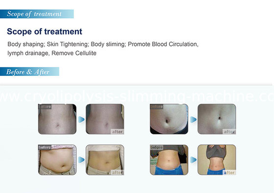 Cryolipolysis cool body sculpting machine with 5 handles two handles work together