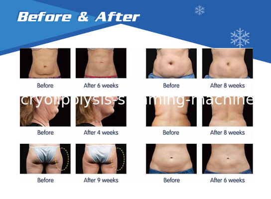 Cryolipolysis RF cavitation 3 in 1 Multifunctional Cryolipolysis Slimming Machine Vertical With 5 Handles