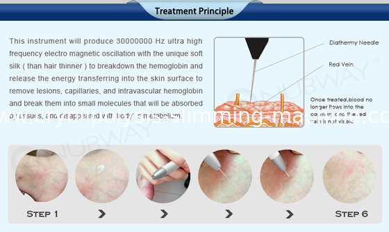 30MHZ professional sloan used immediately result high quality Spider Vein Removal Machine