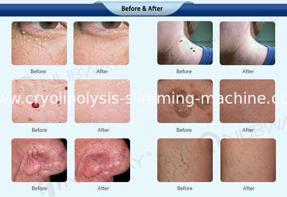30MHZ professional sloan used immediately result high quality Spider Vein Removal Machine