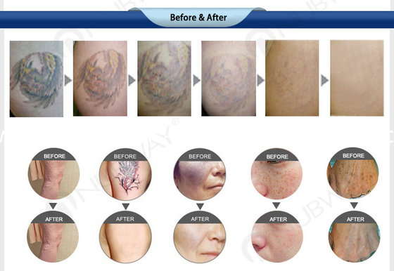 FDA approval big power good result professional top selling  tattoo removal q switch nd yag laser