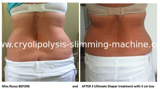 FDA approval best selling and result high quality 500000 shots hifu body slimming machine