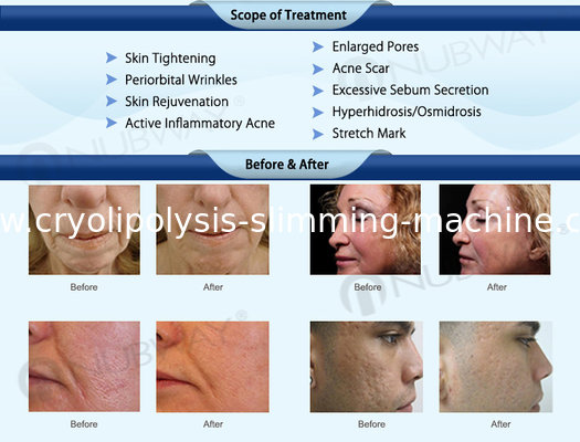 CE approval effective result factory price 25 pin 49 pin 81 pin face lifting RF microneedle machine