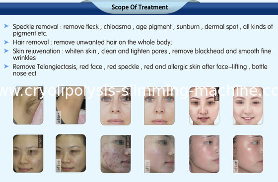 Factory price effective result powerful acne pigment removal IPL machine for salon