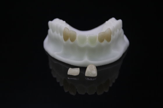 Full Ceramics Porcelain Dental Veneers Metal Free Long Lasting In Cosmetic Dentistry