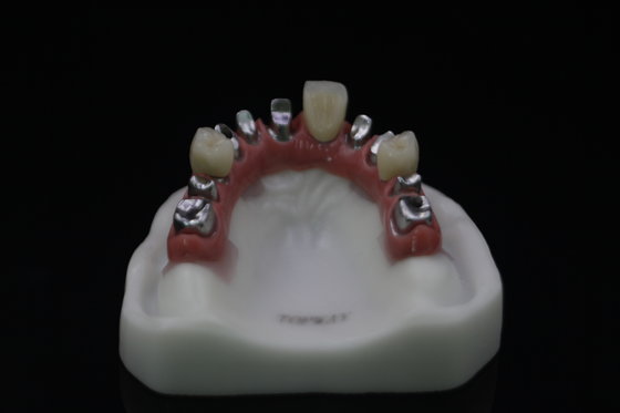 PFM Porcelain Fused To Metal Crown , Temporary / Permanent Bridge For Teeth
