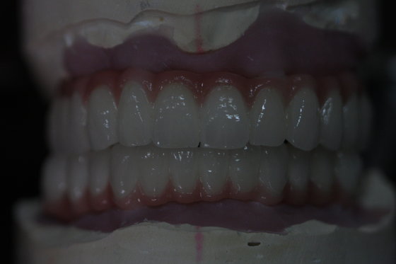PFM Porcelain Fused To Metal Crown , Temporary / Permanent Bridge For Teeth