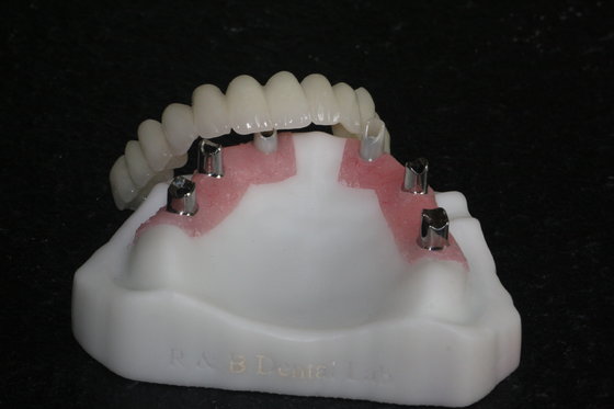 PFM Porcelain Fused To Metal Crown , Temporary / Permanent Bridge For Teeth