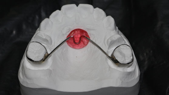 Functional Appliances In Orthodontics , Anti - Snoring Device Mouth Guard