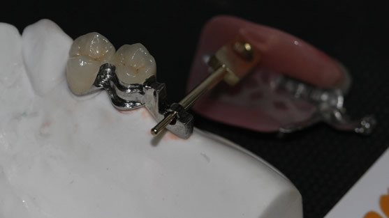 Metal Dental Precision Attachments , Tooth Telescope Attachments For Partial Denture