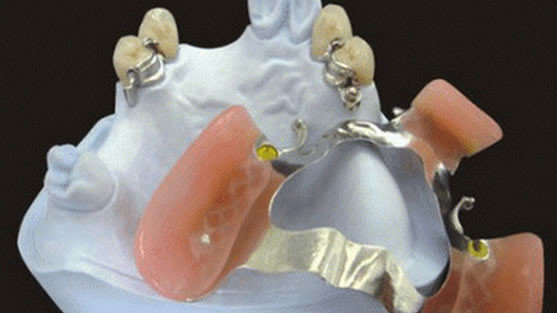 Metal Dental Precision Attachments , Tooth Telescope Attachments For Partial Denture