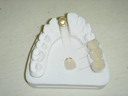Captek Nanogold , Captek Classical Crown for any posterior tooth restoration