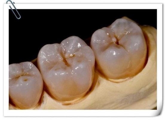 UPCERA Zir Solid Zirconia Dental Crown Tooth Cap For Dental Lab Strong Hardness