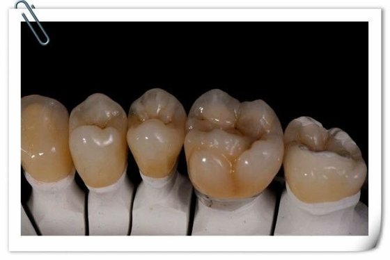 Lava Zirconia Full Ceramic Tooth Implant Bridge With Good Biocompatibility