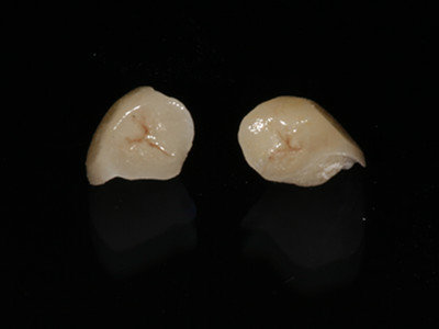 Composite Dental Inlays And Onlays For Restore Small Surface Damage
