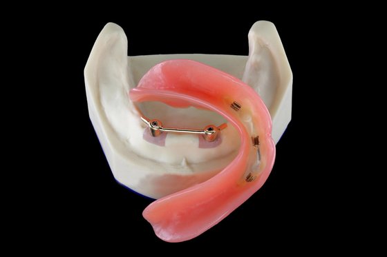 Bar And Clip / Sleeve Dental Tooth Attachment No Discolor Excellent Biocompatibility